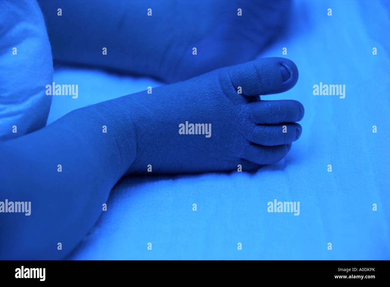 Premature baby with jaundice having phototherapy Stock Photo - Alamy