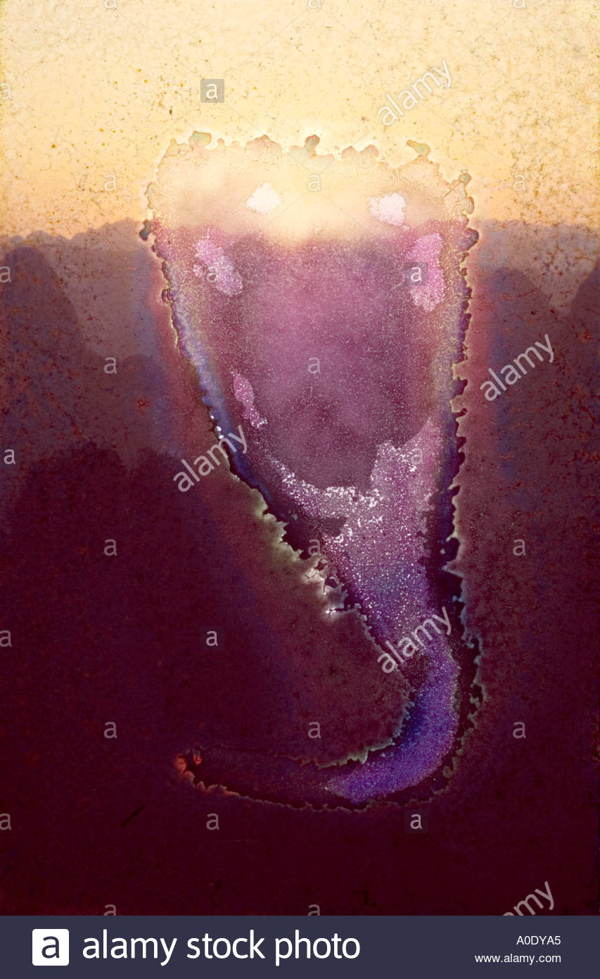 Acid Burn Stock Photos & Acid Burn Stock Images - Alamy