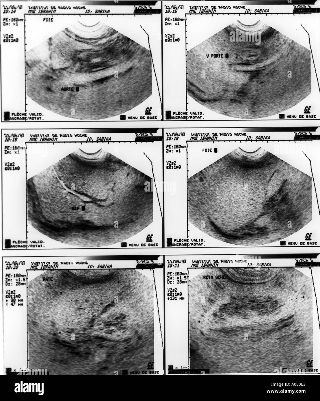 Abdominal Ultrasound Scan Stock Photo - Alamy