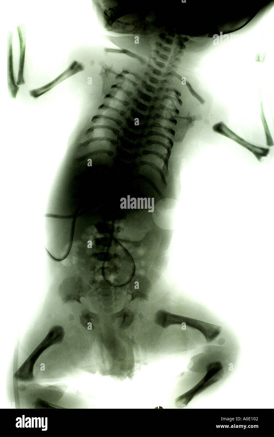 X Ray of infant Stock Photo - Alamy