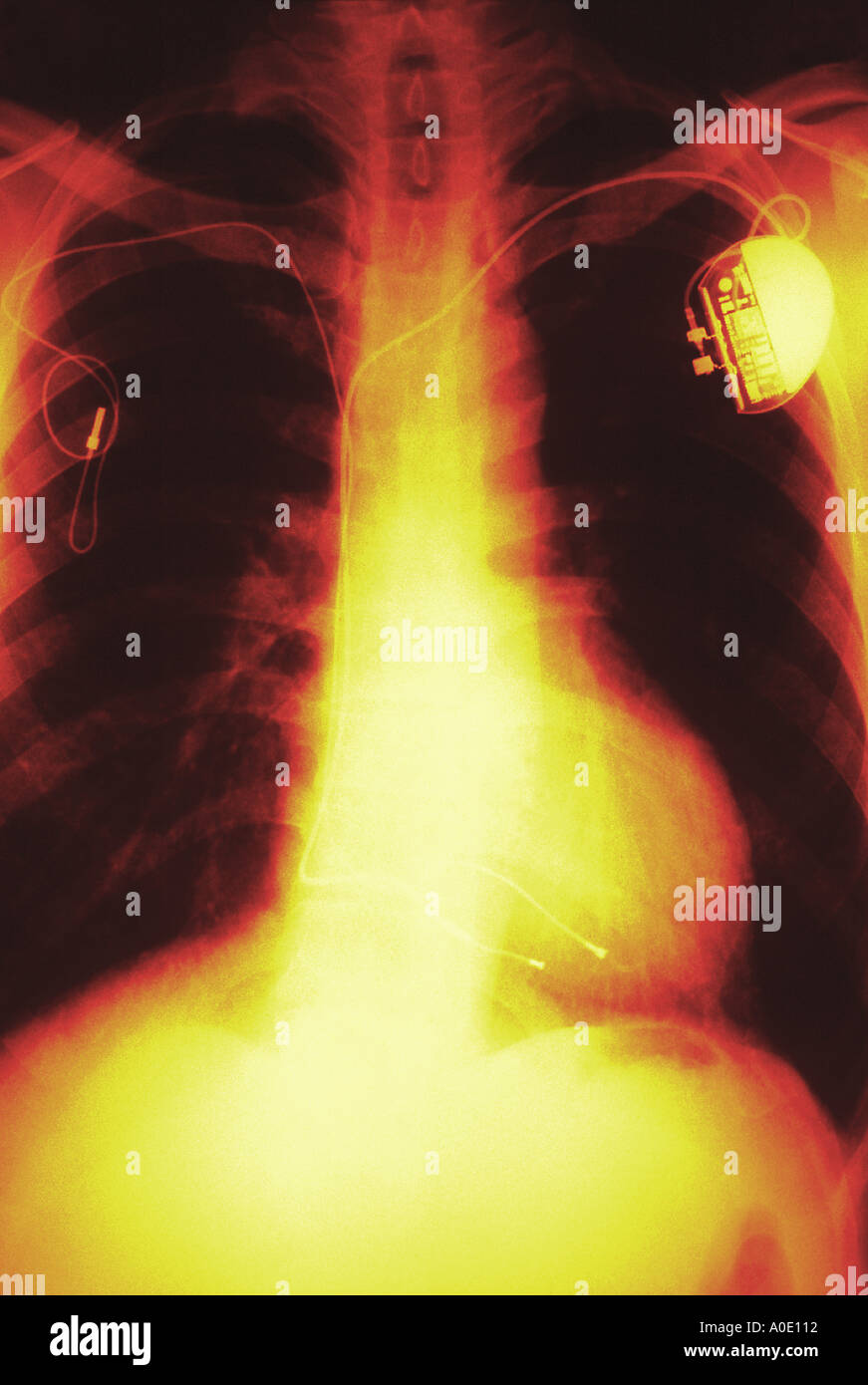 X ray of heart Pacemaker Stock Photo - Alamy