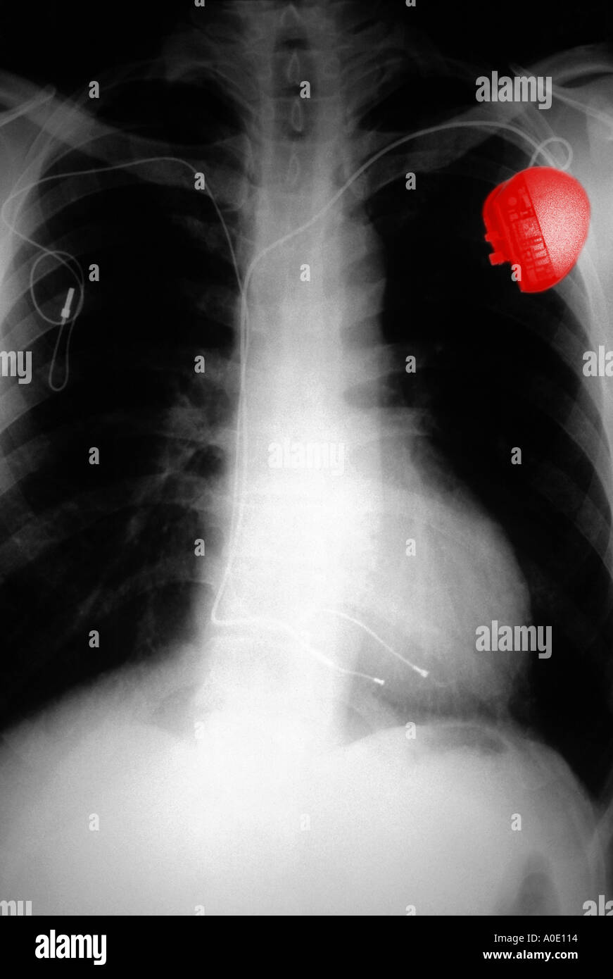 X ray of heart Pacemaker Stock Photo - Alamy