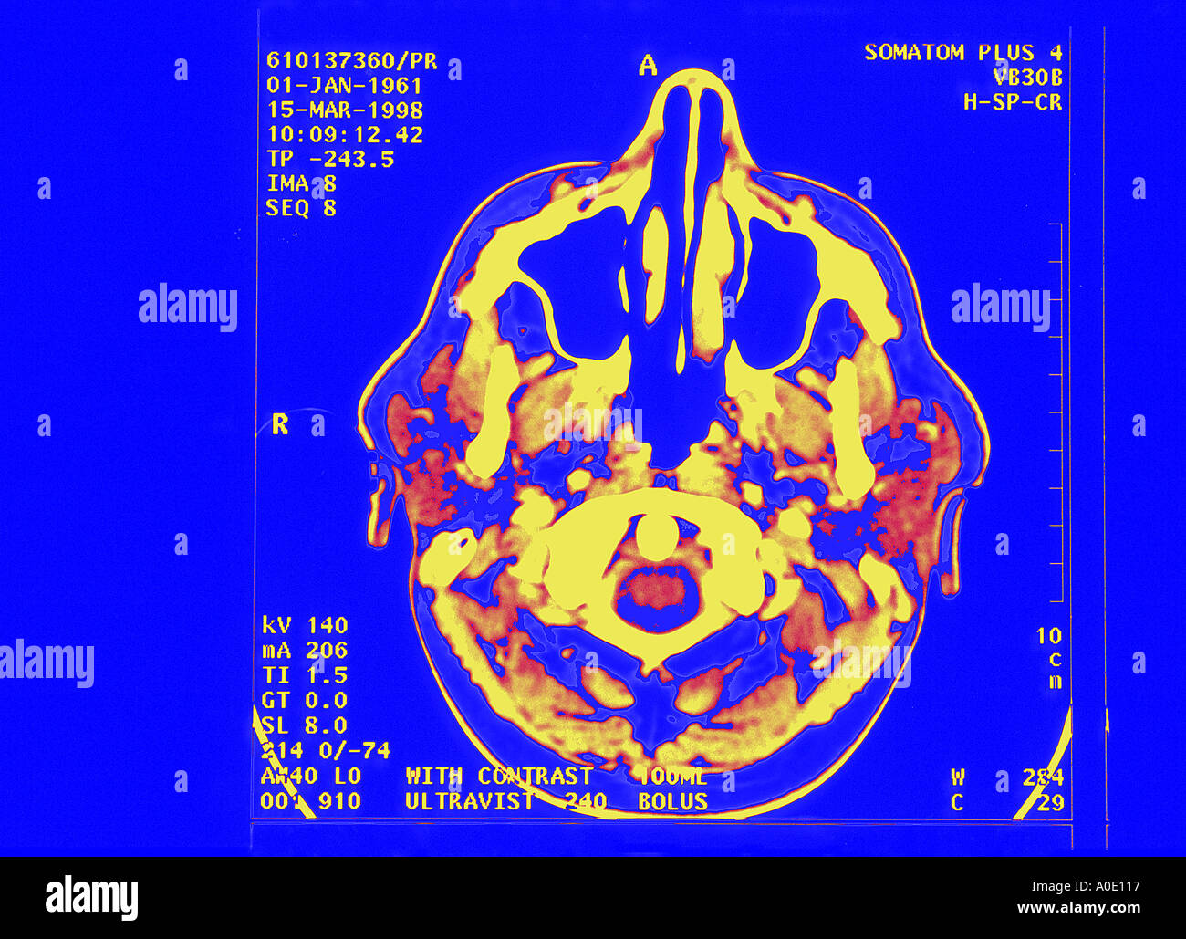 Coloured mri brain scan hi-res stock photography and images - Alamy