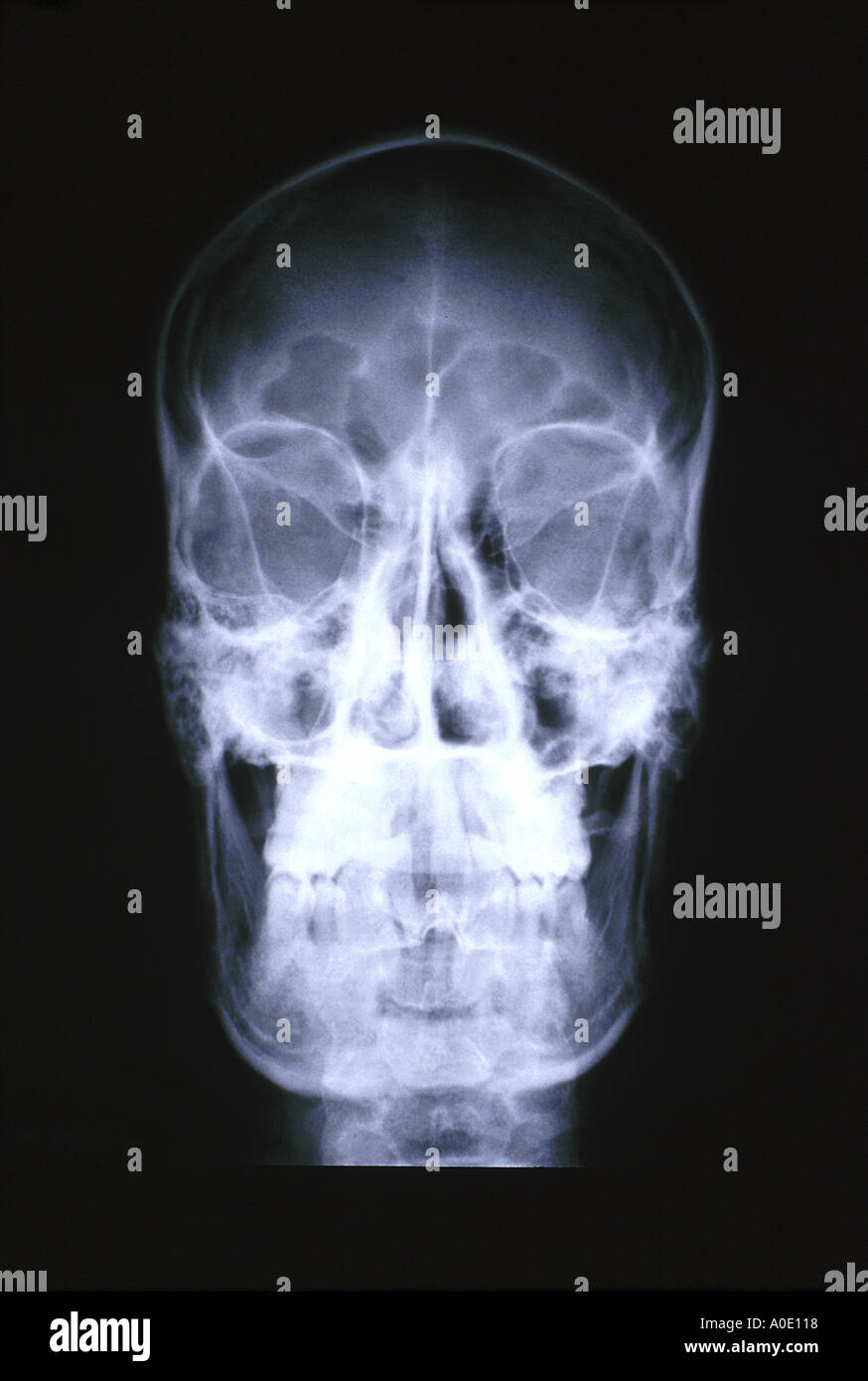 Skull Xray High Resolution Stock Photography and Images - Alamy