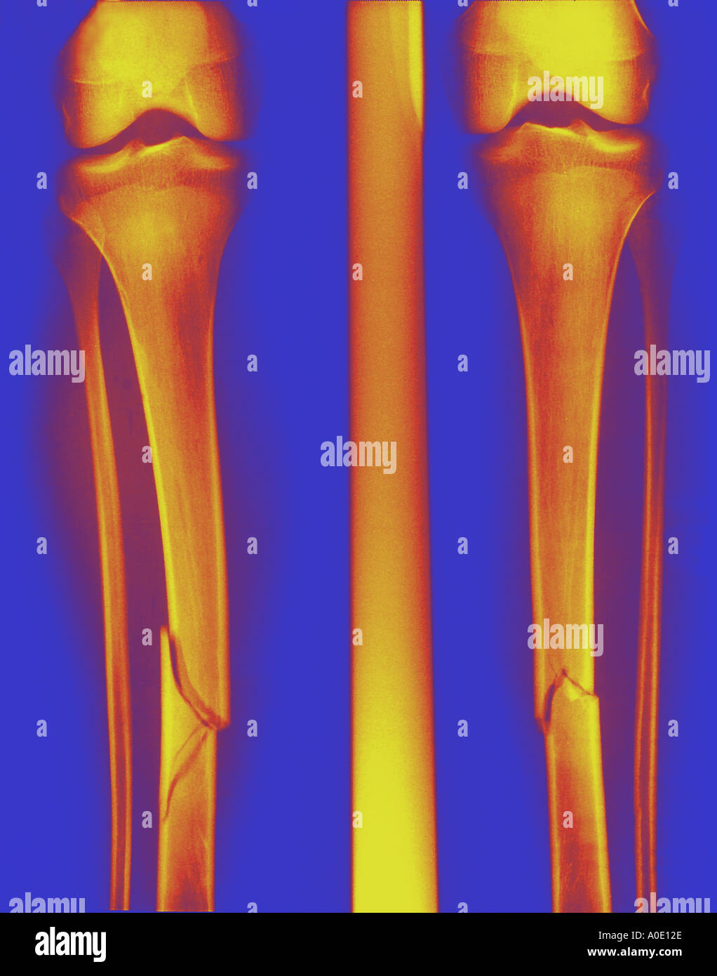 Fractured tibia hi-res stock photography and images - Alamy