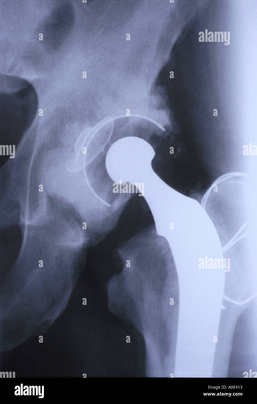 Artificial Hip Joint Stock Photos & Artificial Hip Joint Stock Images ...