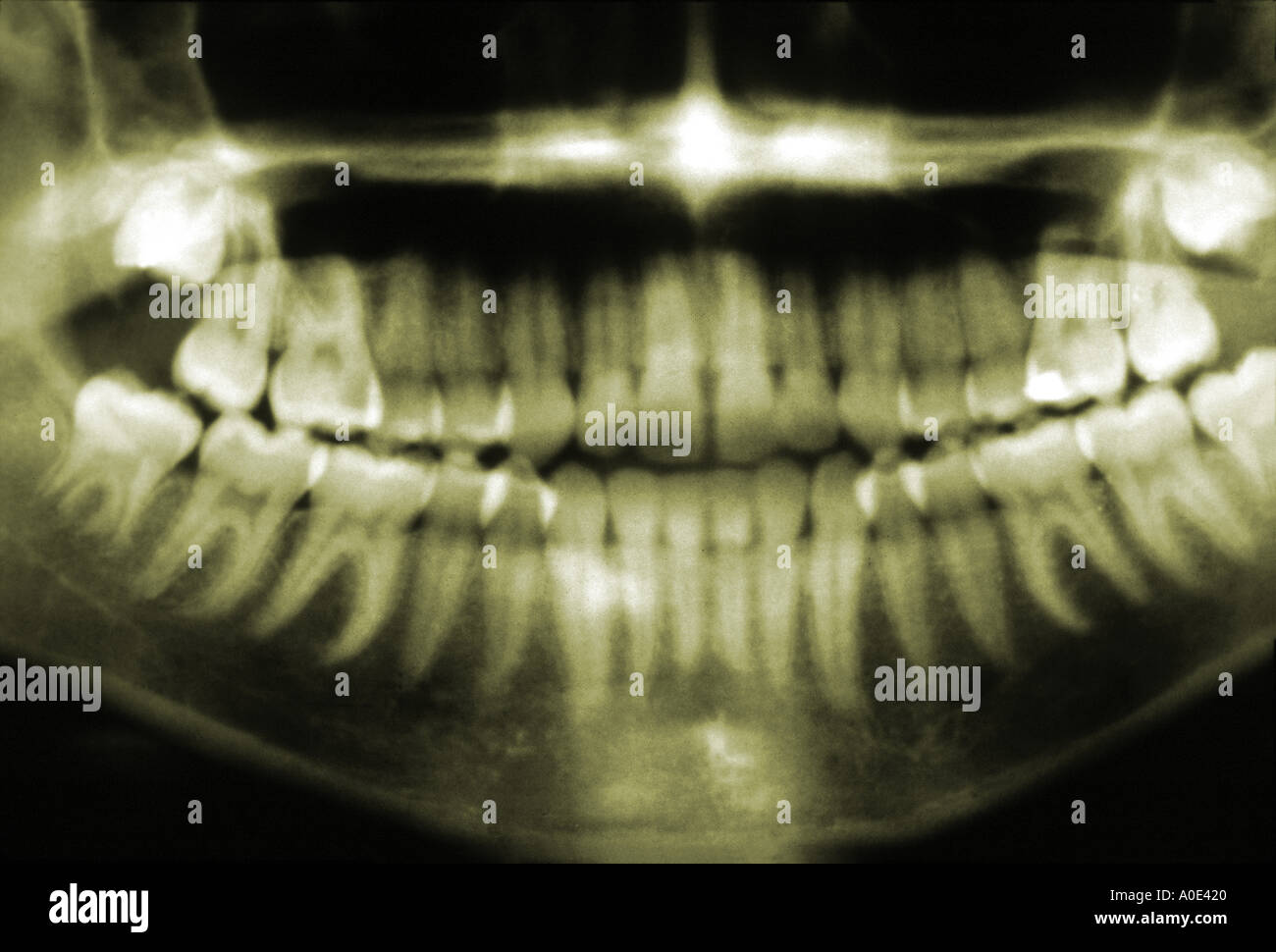 Dental X Ray Stock Photo - Alamy