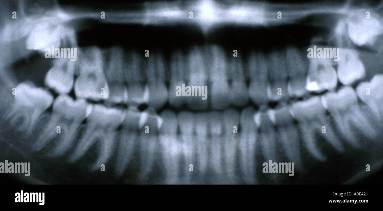 Panoral x ray hi-res stock photography and images - Alamy