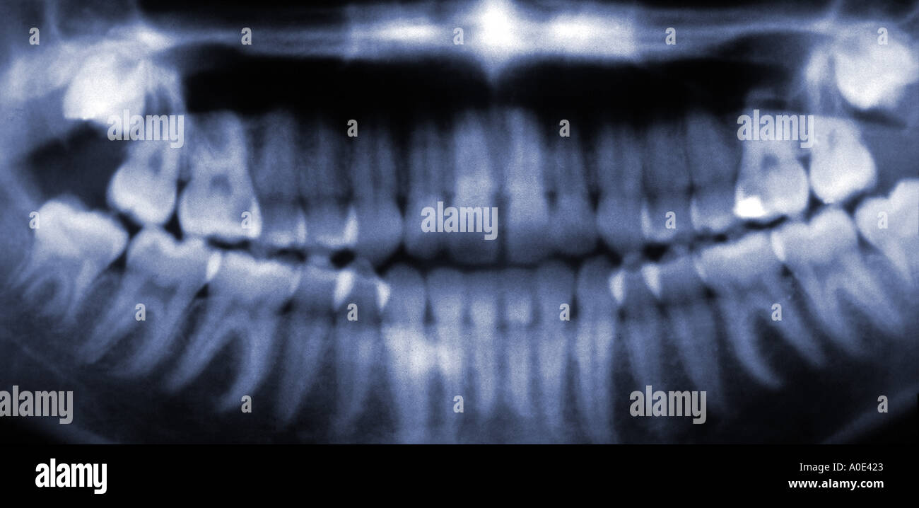 Dental X ray Stock Photo - Alamy