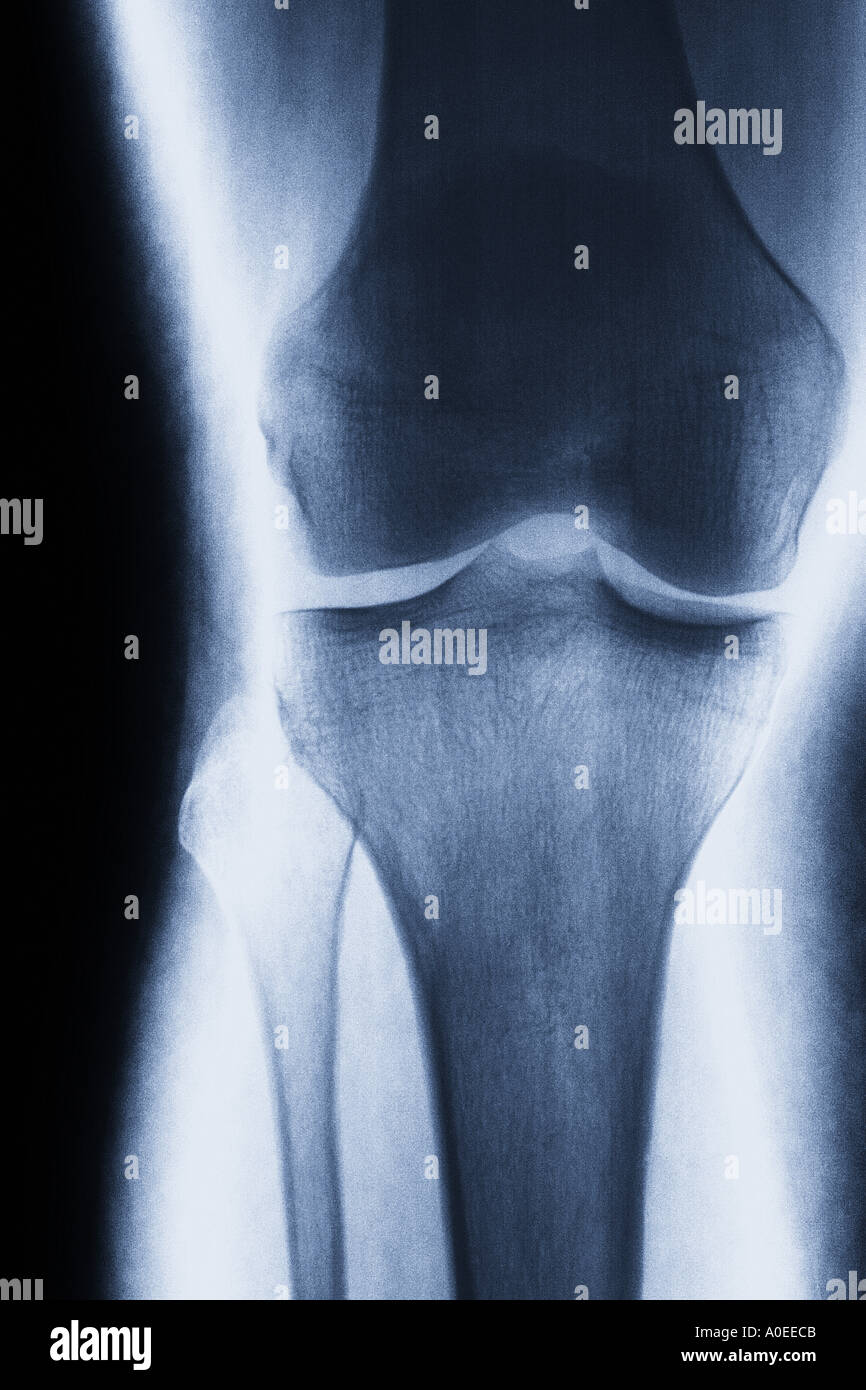 x ray of knee Stock Photo - Alamy