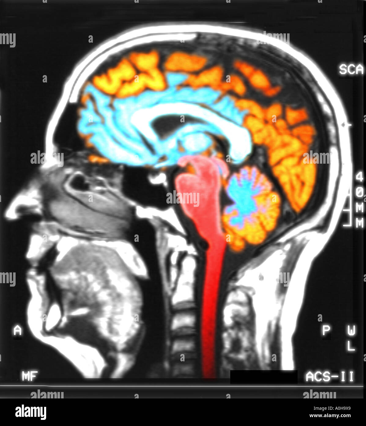 MRI scan of a human head Stock Photo - Alamy