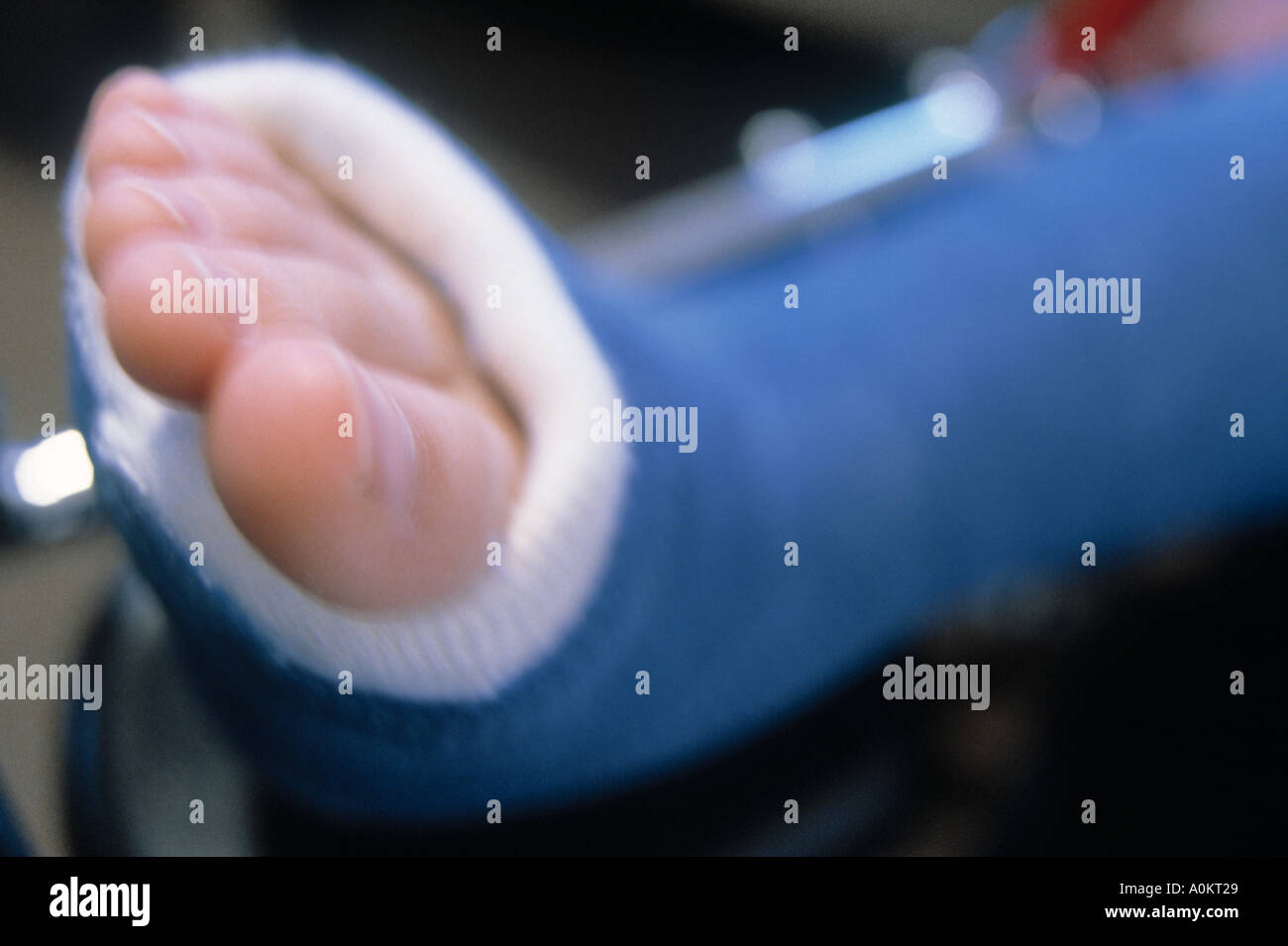 young child with broken leg in plaster cast Stock Photo - Alamy