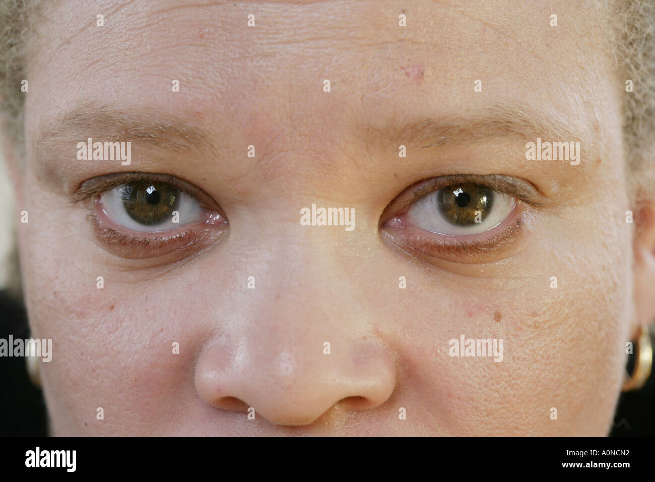 Part of a series of nine gaze positions.Search on CMSP NYSTAGMUS to see ...
