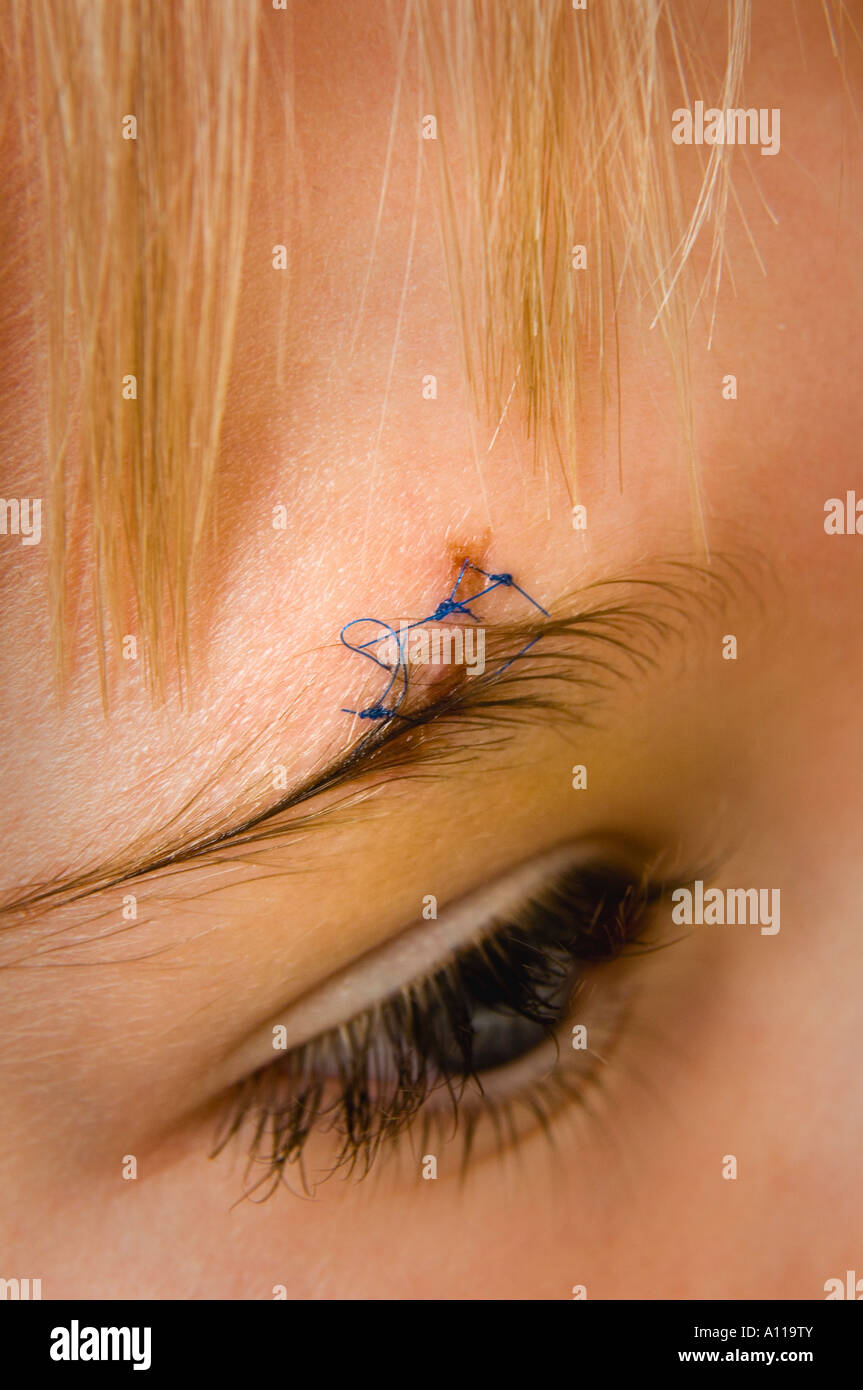 Girl with stitches Stock Photo - Alamy