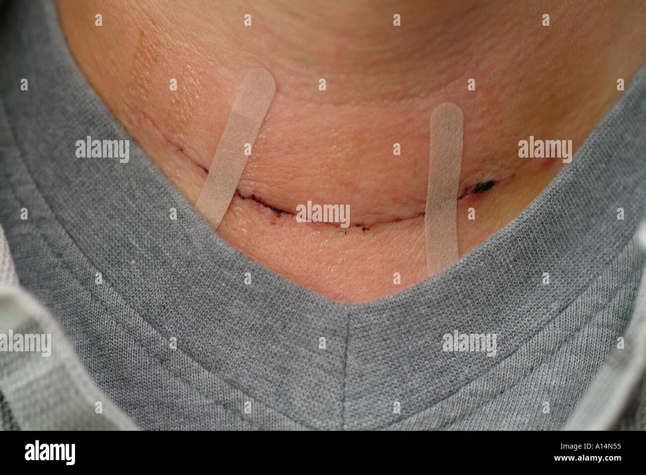 Neck scar hi-res stock photography and images - Alamy