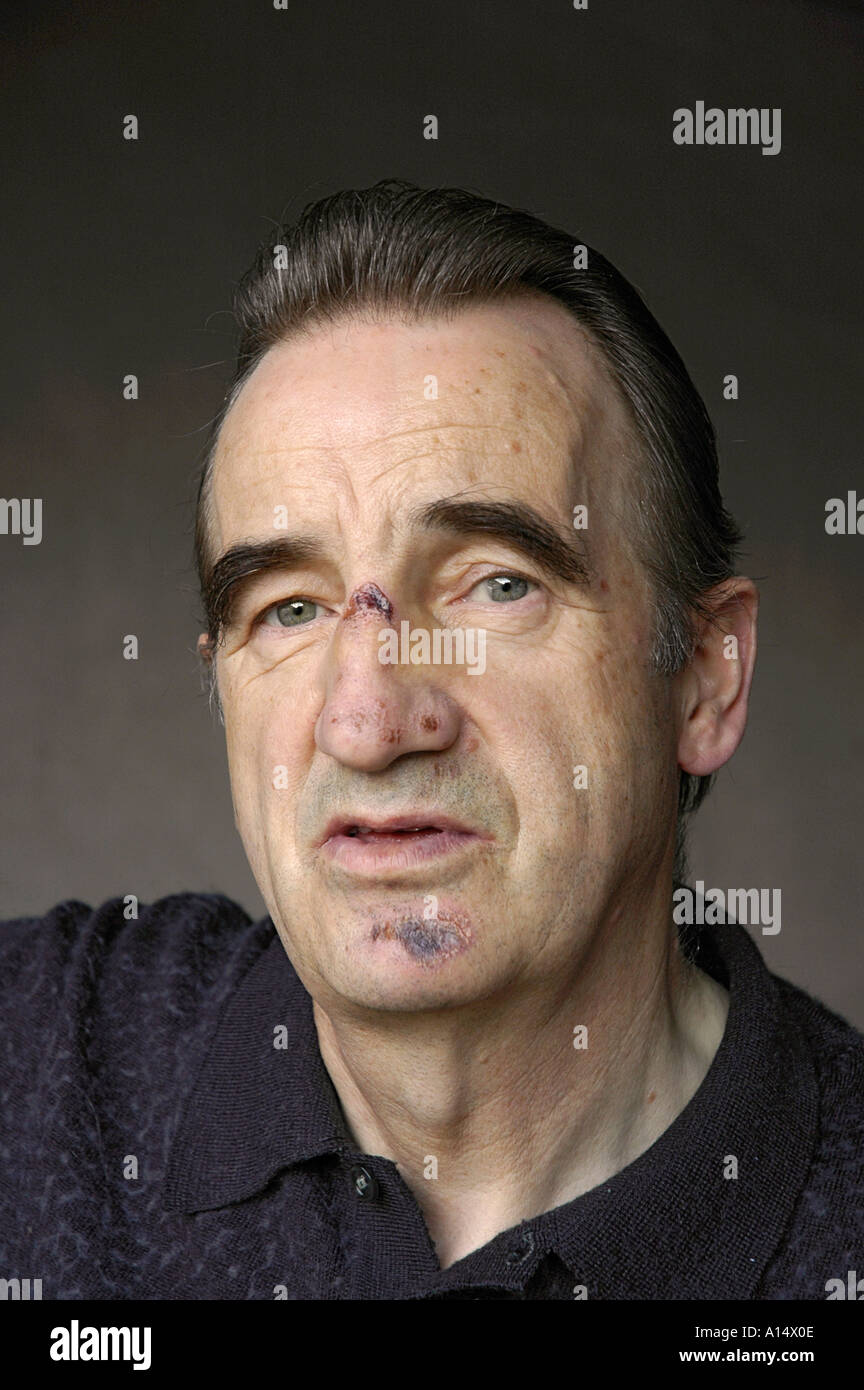 man with damage face Stock Photo - Alamy