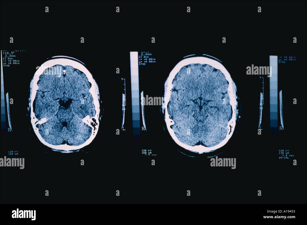 CT scans of a human brain Stock Photo - Alamy