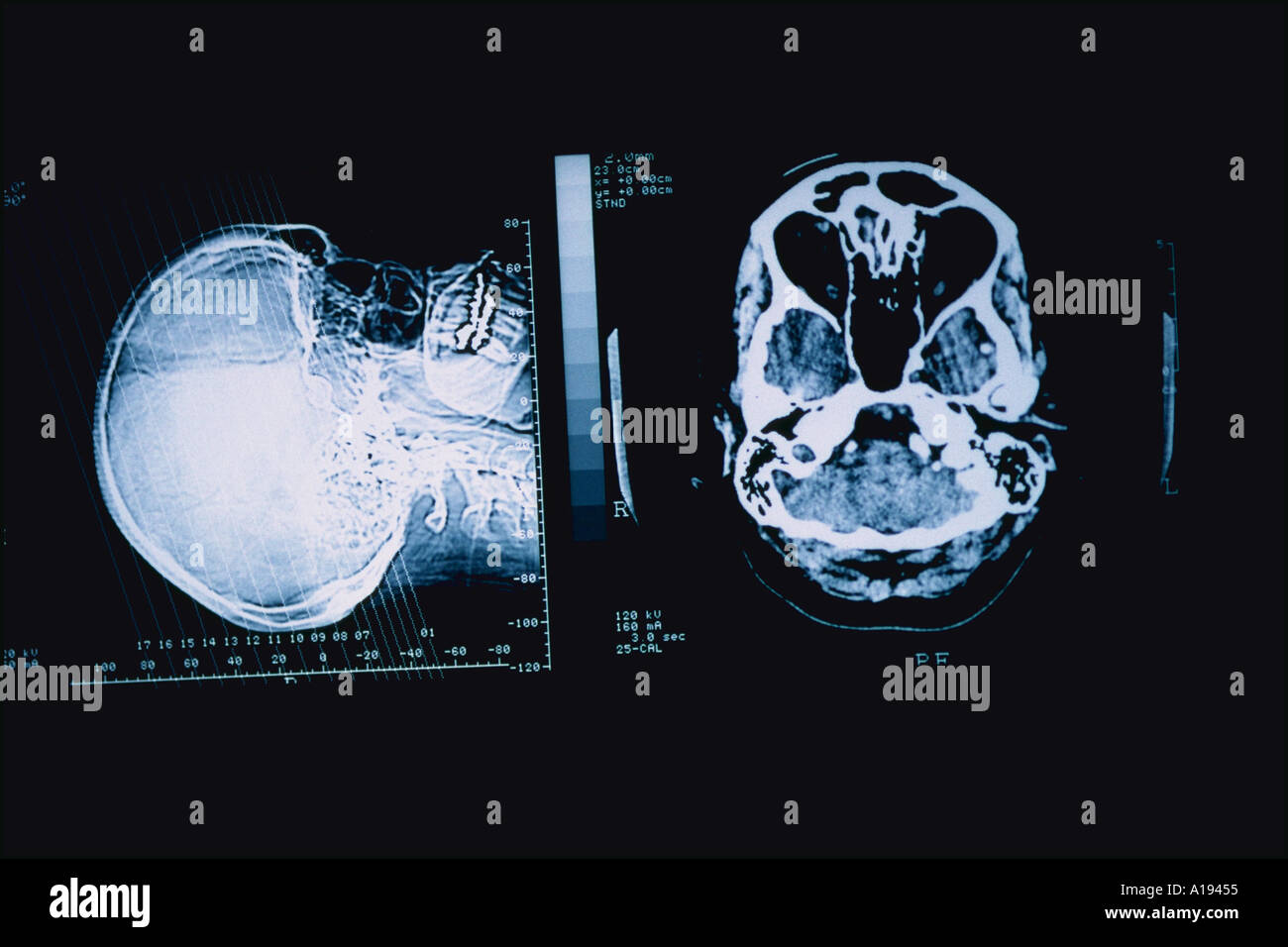 CT scans of a human skull and brain Stock Photo - Alamy