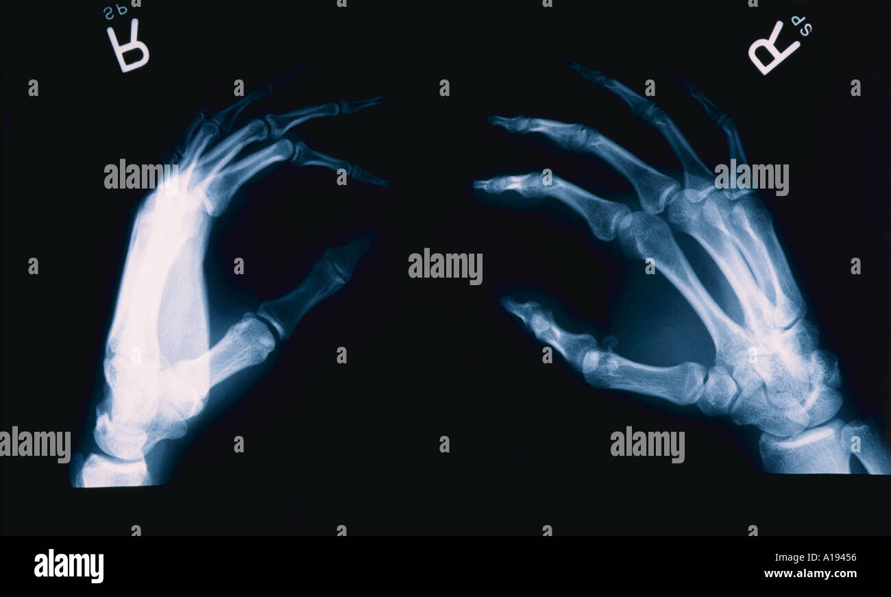 X ray of human hands Stock Photo - Alamy