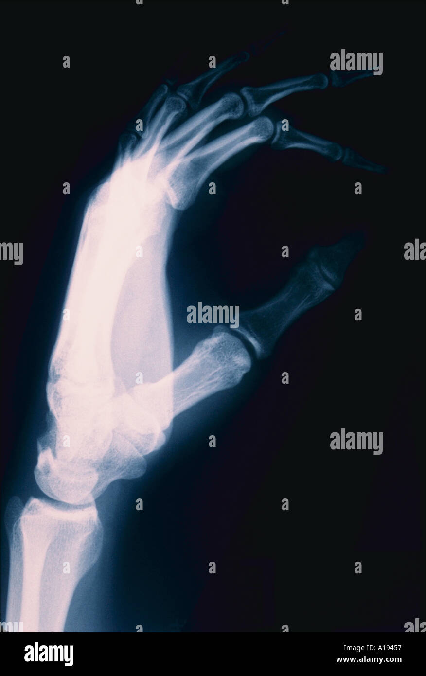 X ray of human hand Stock Photo - Alamy
