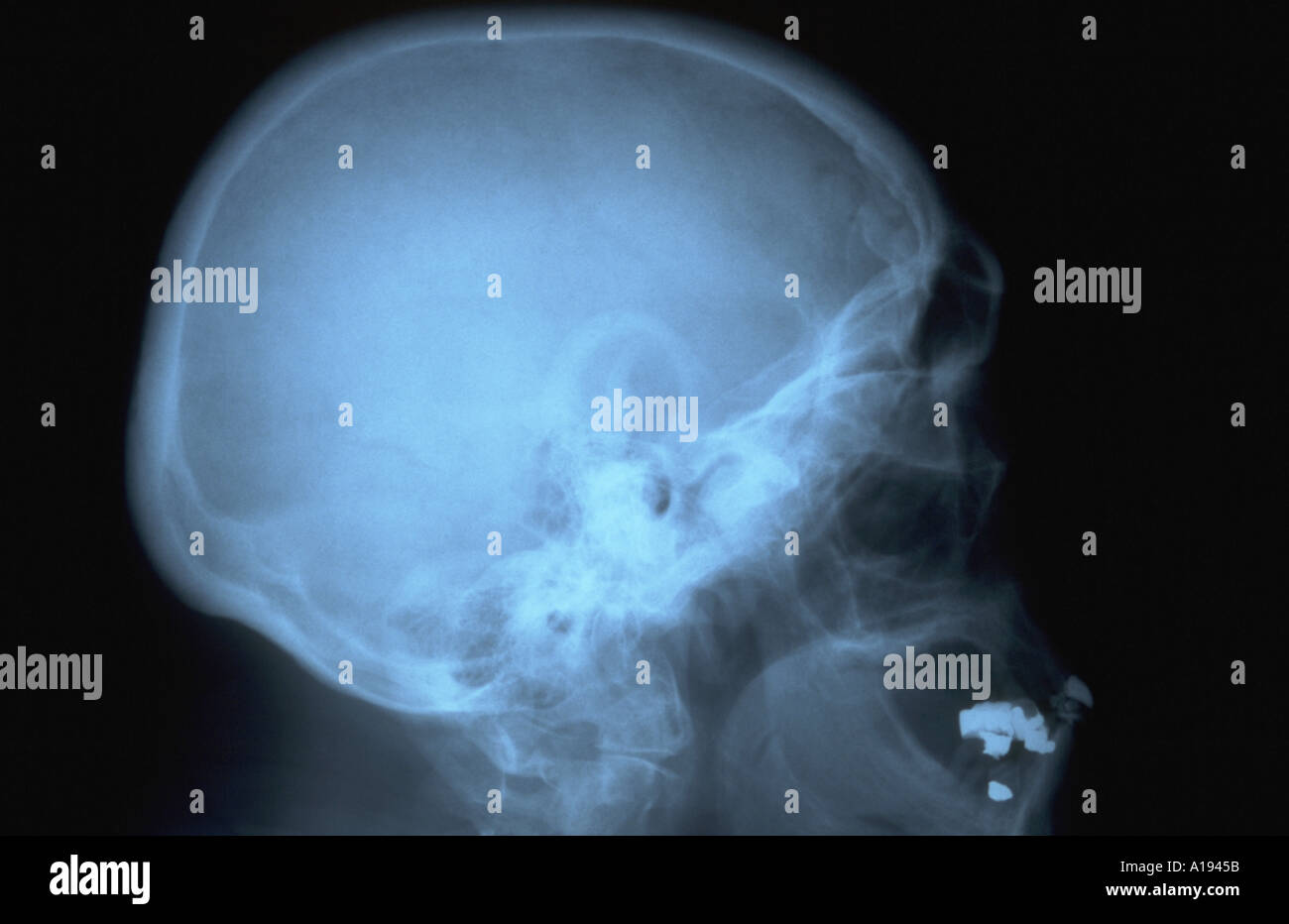 X ray showing a side view of a human skull Stock Photo - Alamy