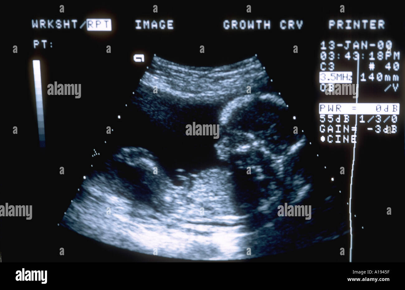 A sonogram image of a fetus in a woman's womb Stock Photo - Alamy