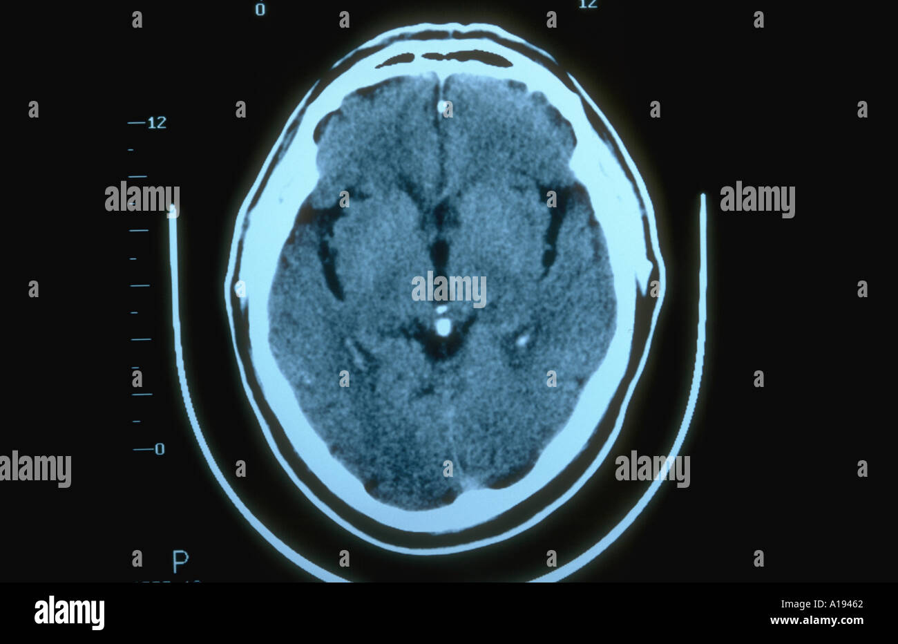 CT scan showing a cross section of a human head Stock Photo - Alamy
