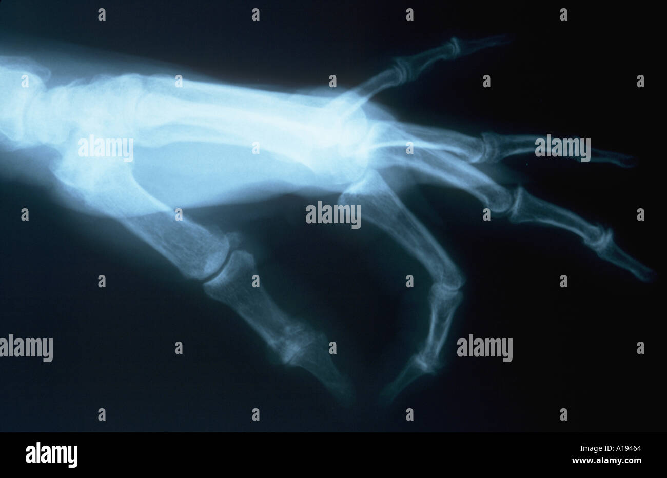 X ray human hand thumb pointer hi-res stock photography and images - Alamy