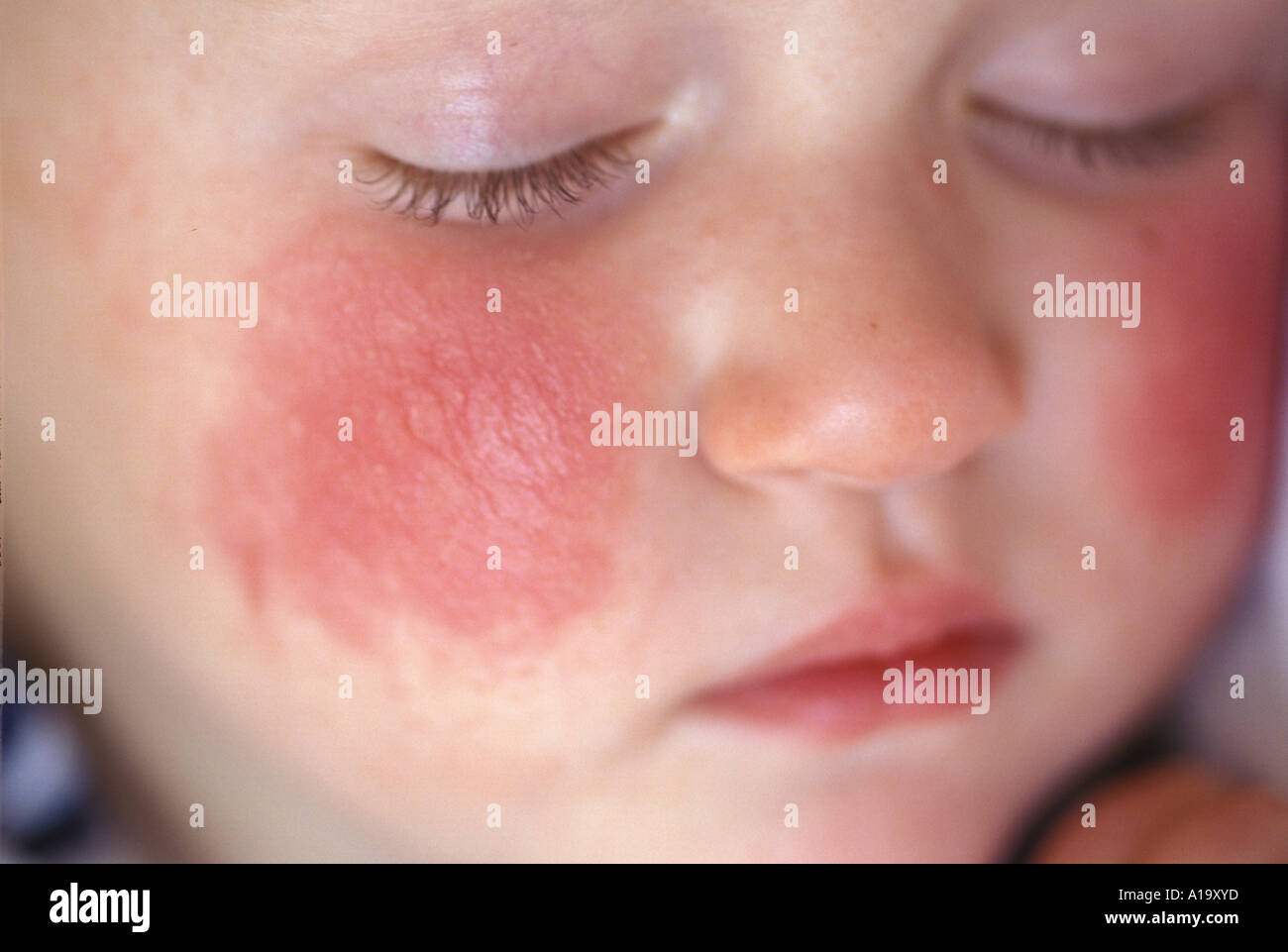 Eczema On Cheeks Eczema On Cheeks