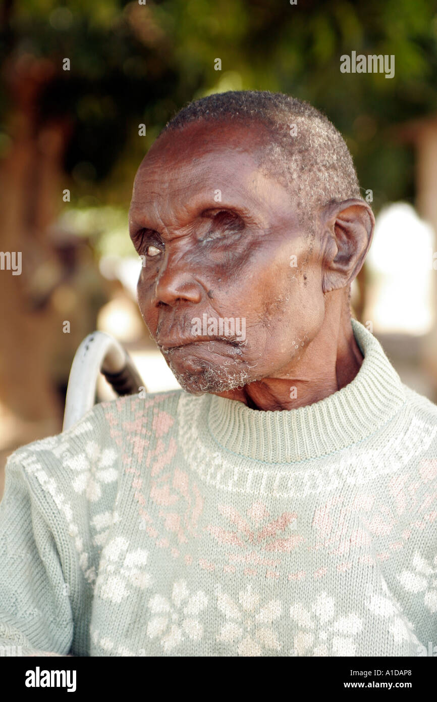 Leper care hi-res stock photography and images - Alamy