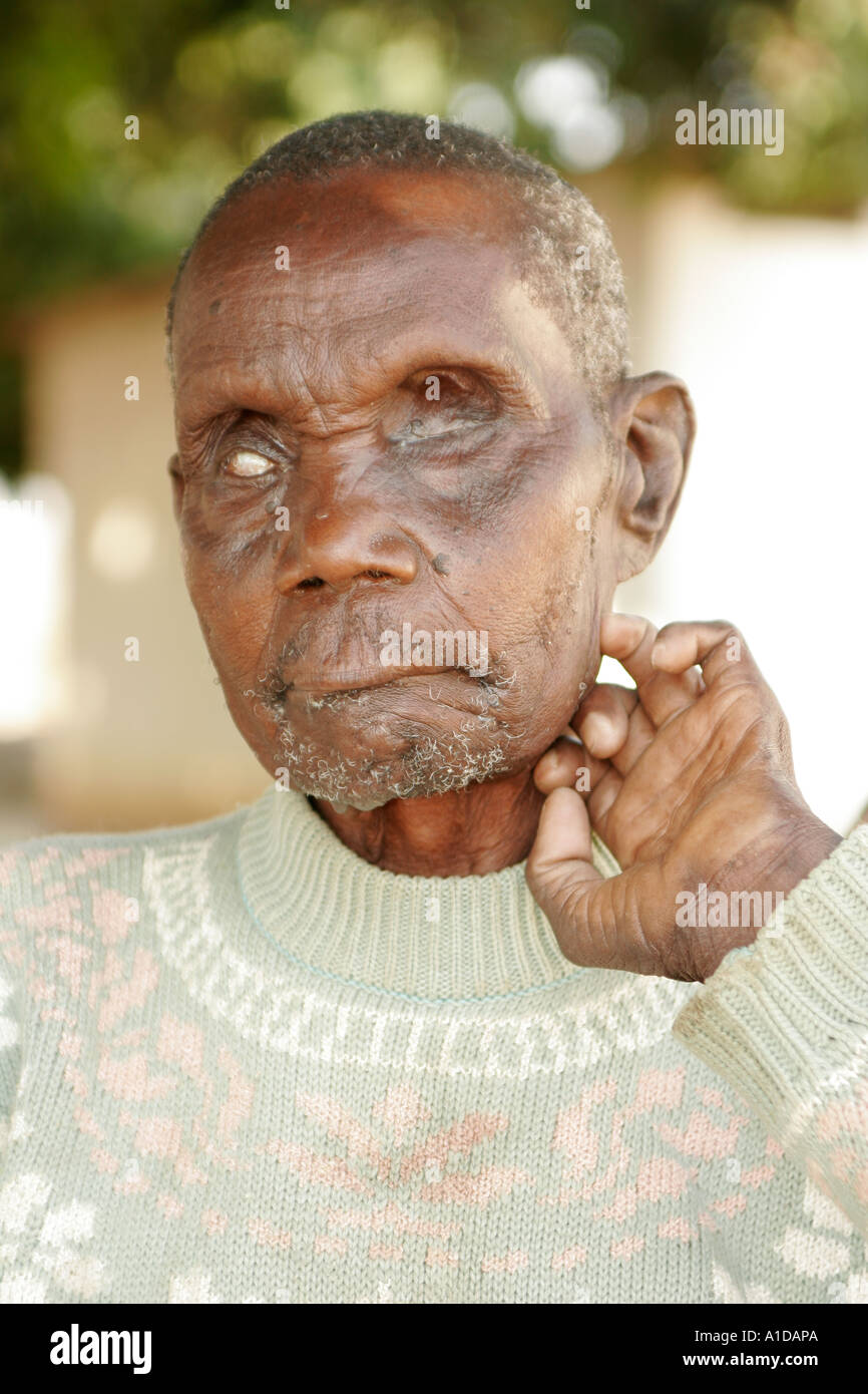 Blind wheelchair bound leper at the Liteta Leper Invalid Compound in ...