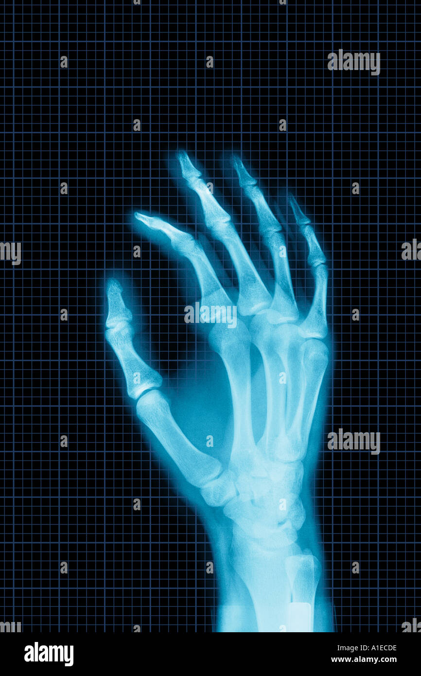 hand x ray Stock Photo - Alamy
