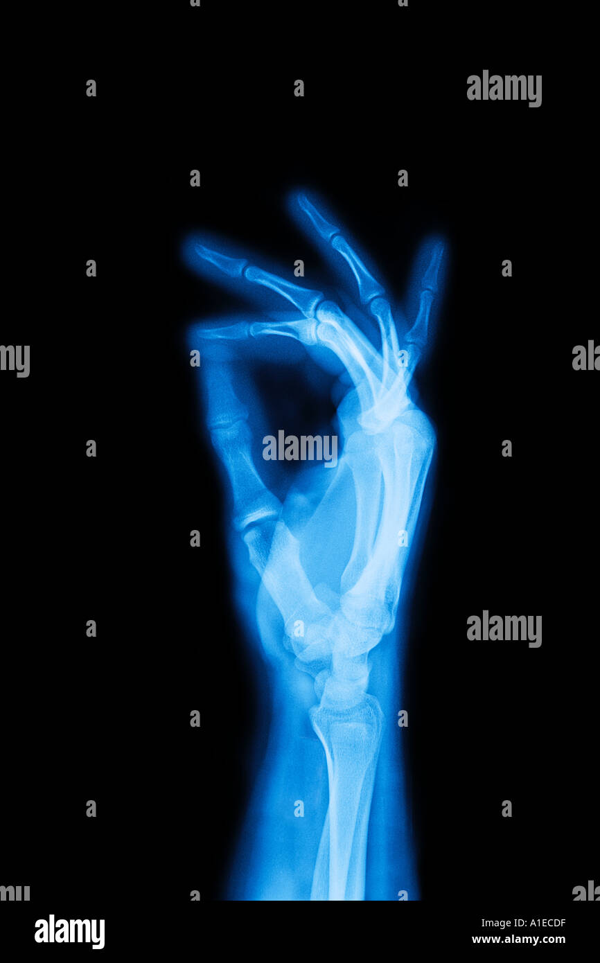 hand x ray Stock Photo - Alamy