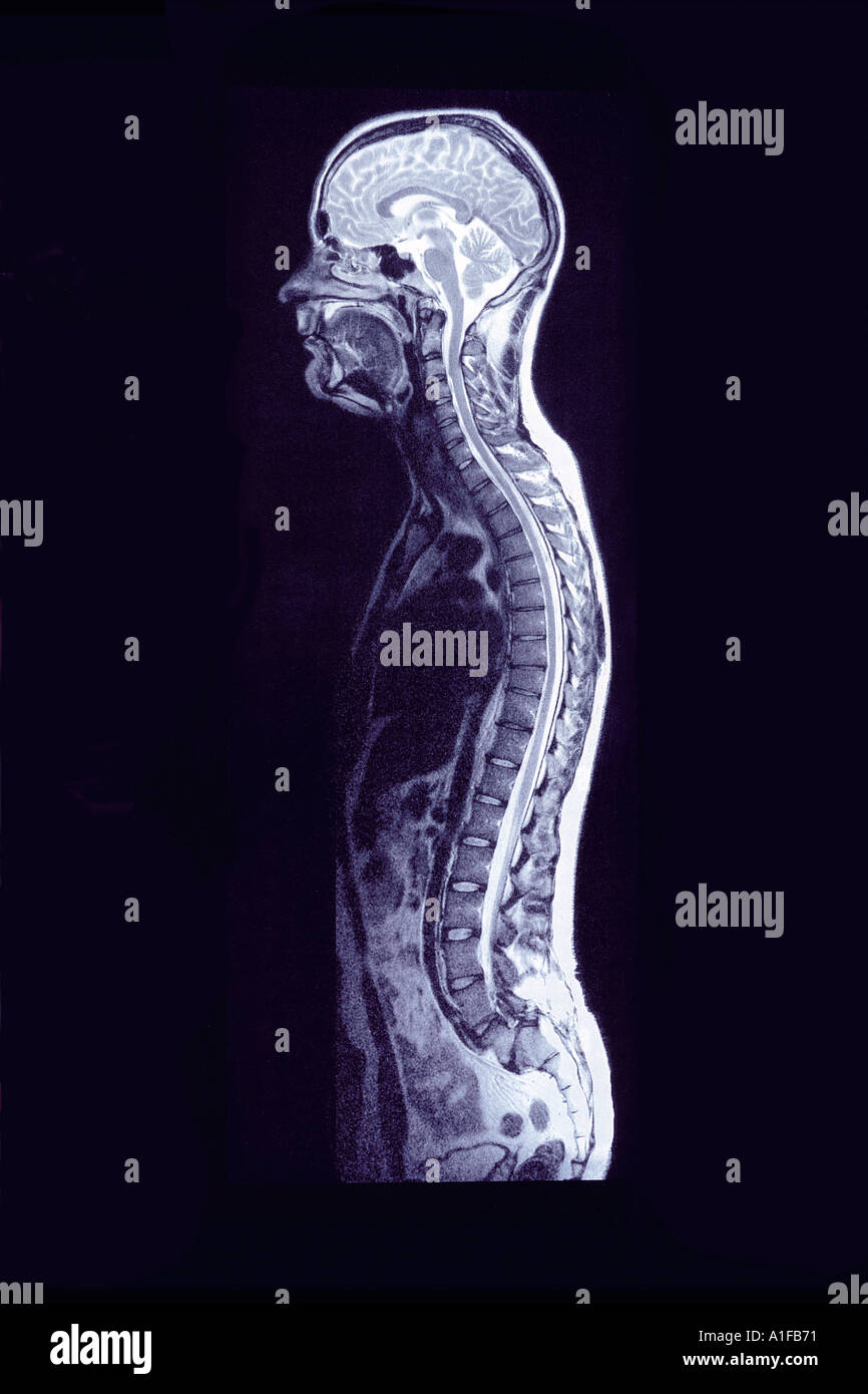 MRI Image of mans skeleton Stock Photo - Alamy