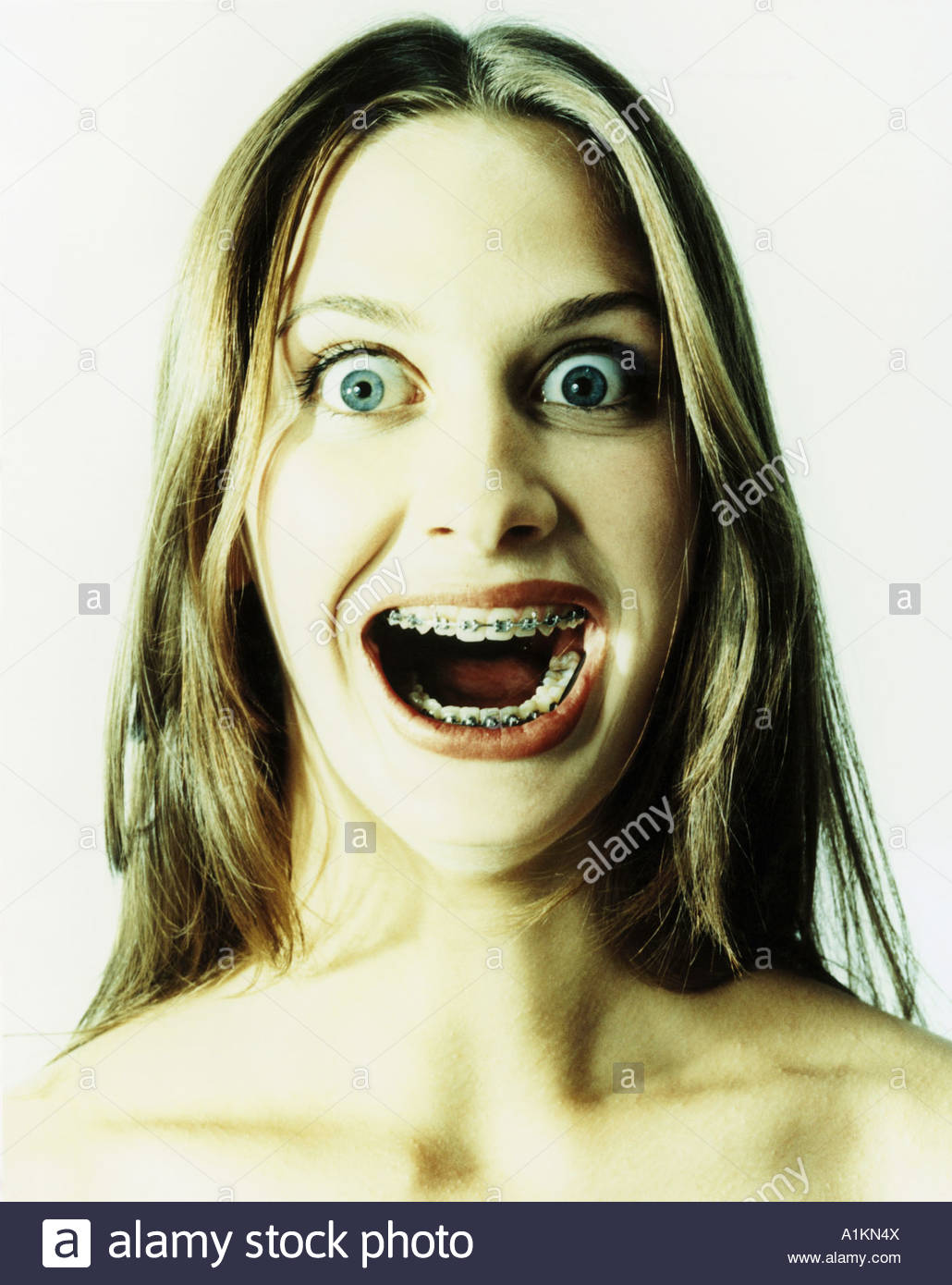 Braces Showing High Resolution Stock Photography and Images - Alamy
