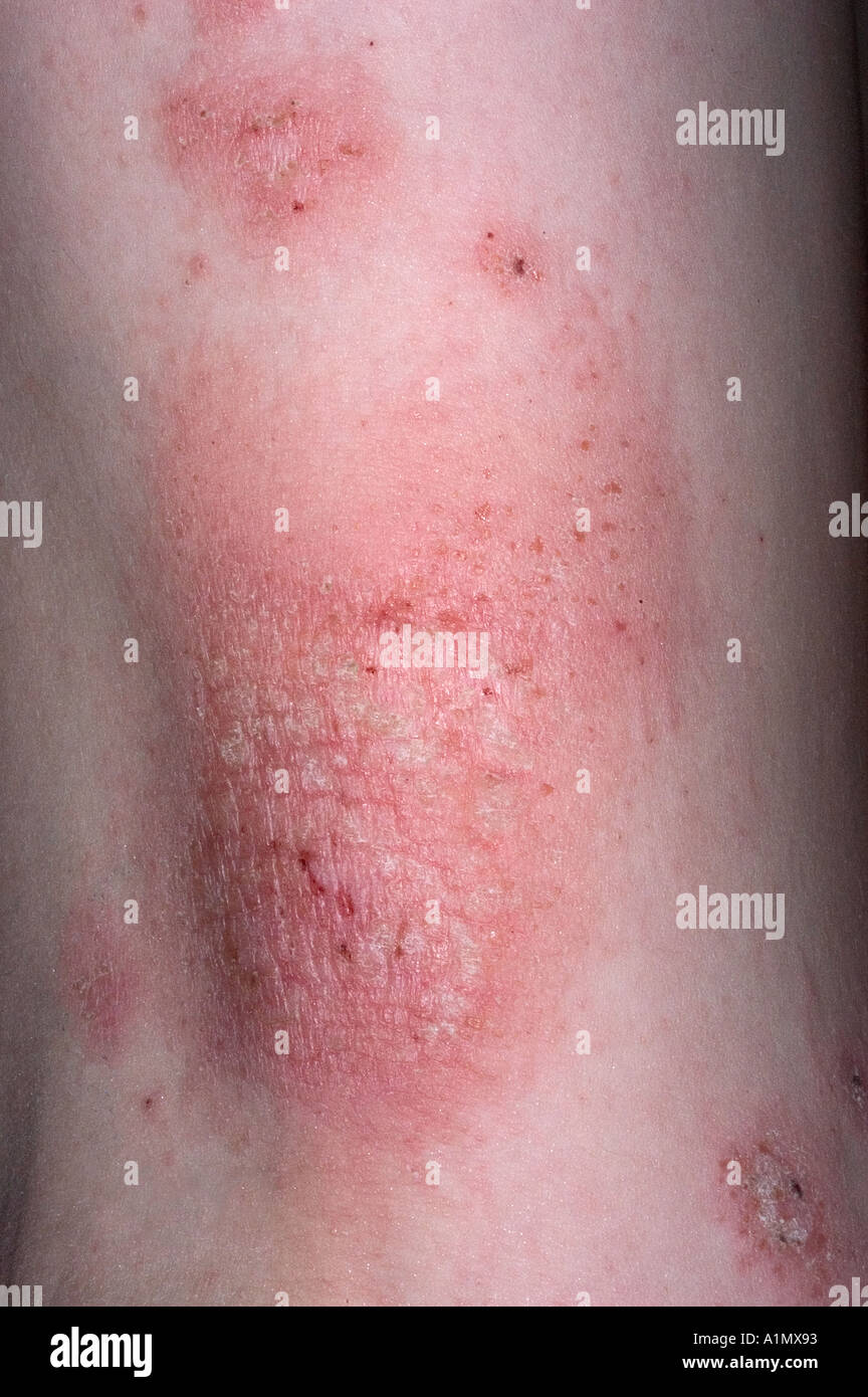 eczema skin rash Stock Photo - Alamy