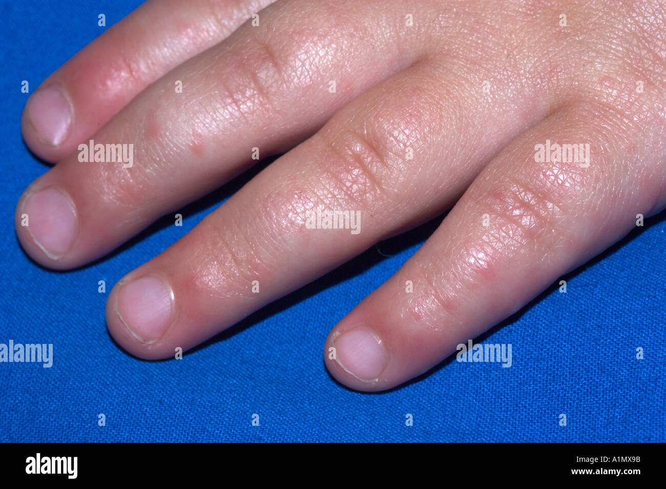 viral exanthem from hand foot and mouth disease Stock Photo - Alamy