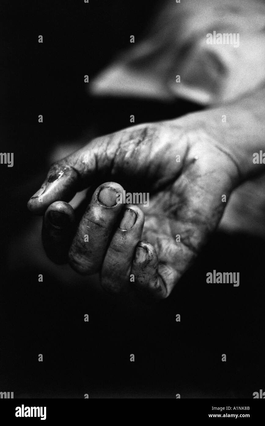 Xhand Startradiology In 2020 Hand Injuries Emergency