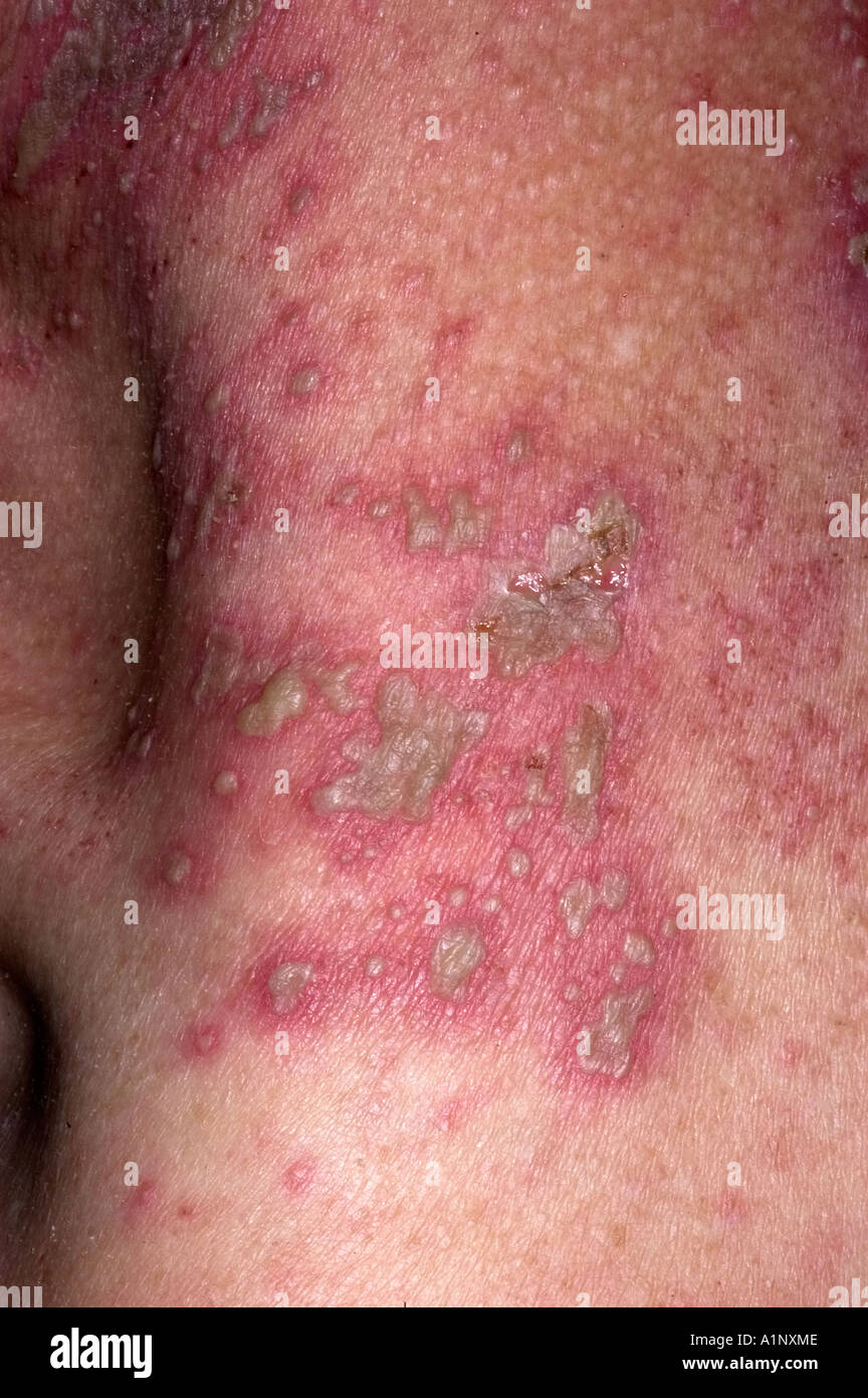 Herpes zoster rash blisters hi-res stock photography and images - Alamy