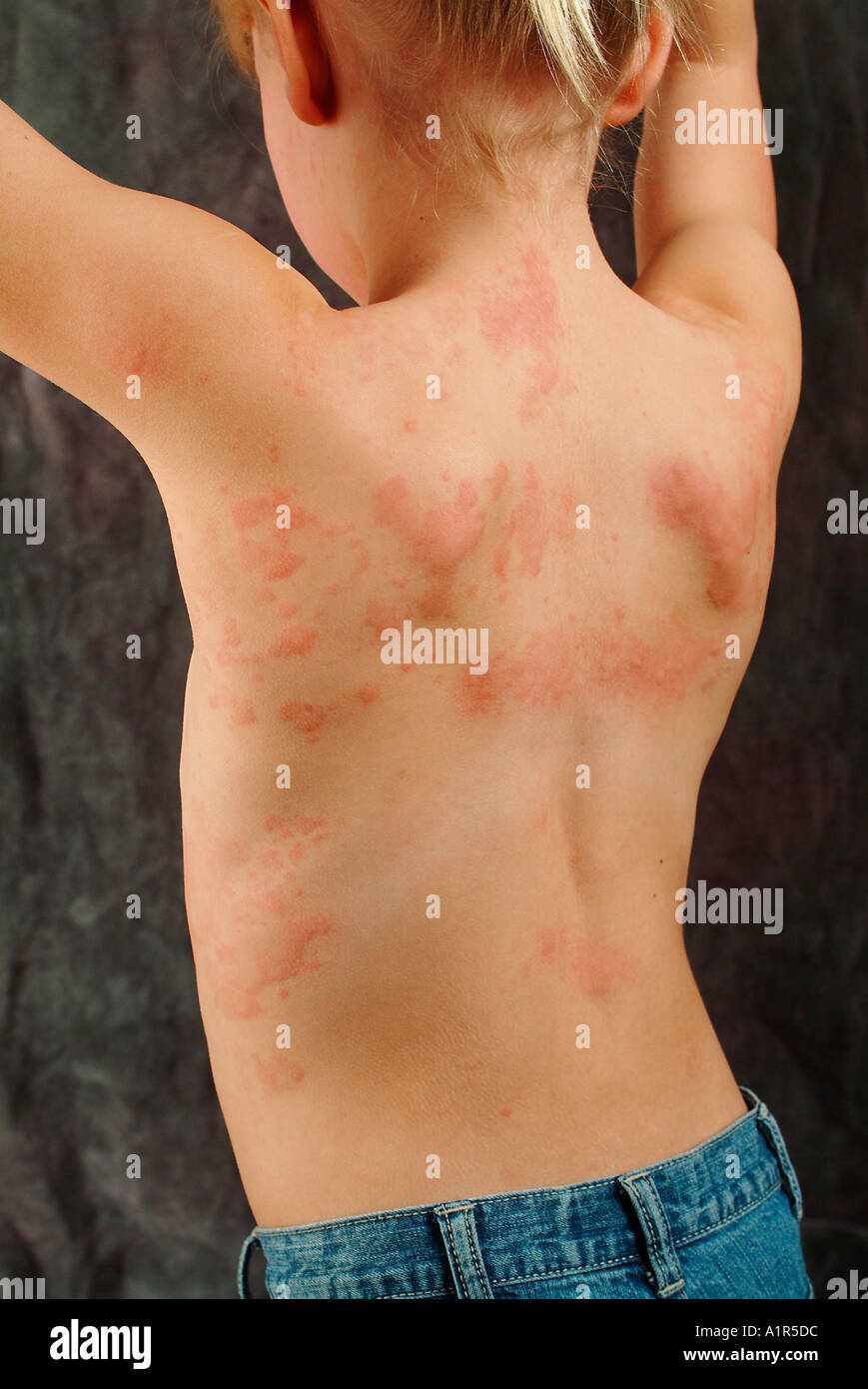 Strep a infection hi-res stock photography and images - Alamy