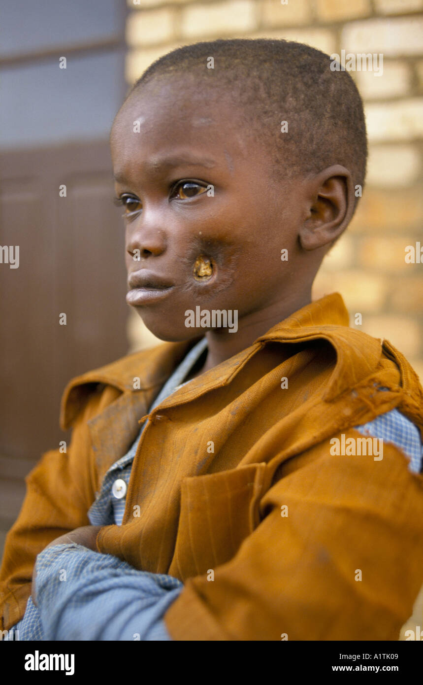 Rwanda ,FREDERIQUE AN ORPHAN SHOT THROUGH THE SIDE OF HIS FACE LIVING ...