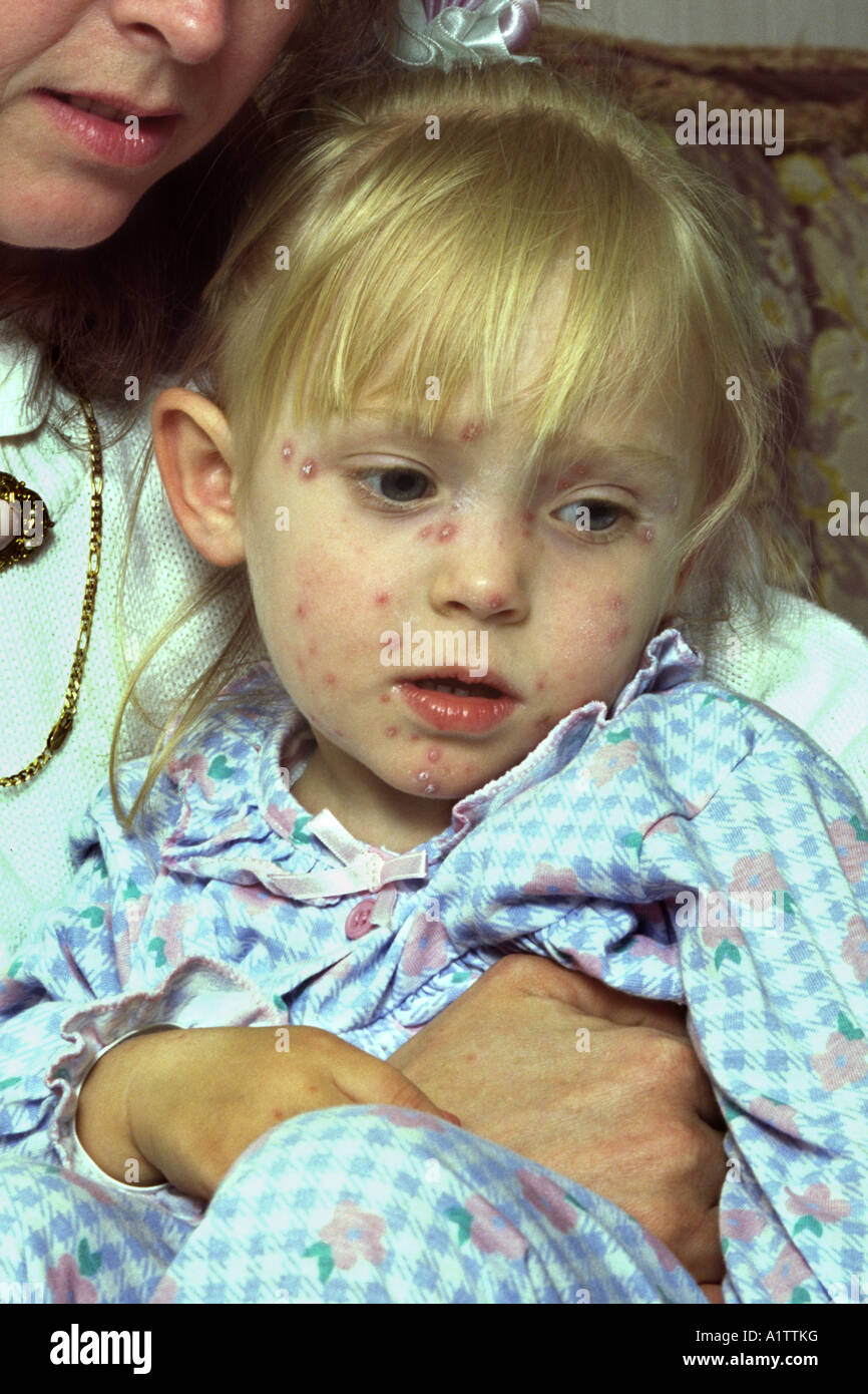 Young girl child suffering with Chickenpox Stock Photo - Alamy