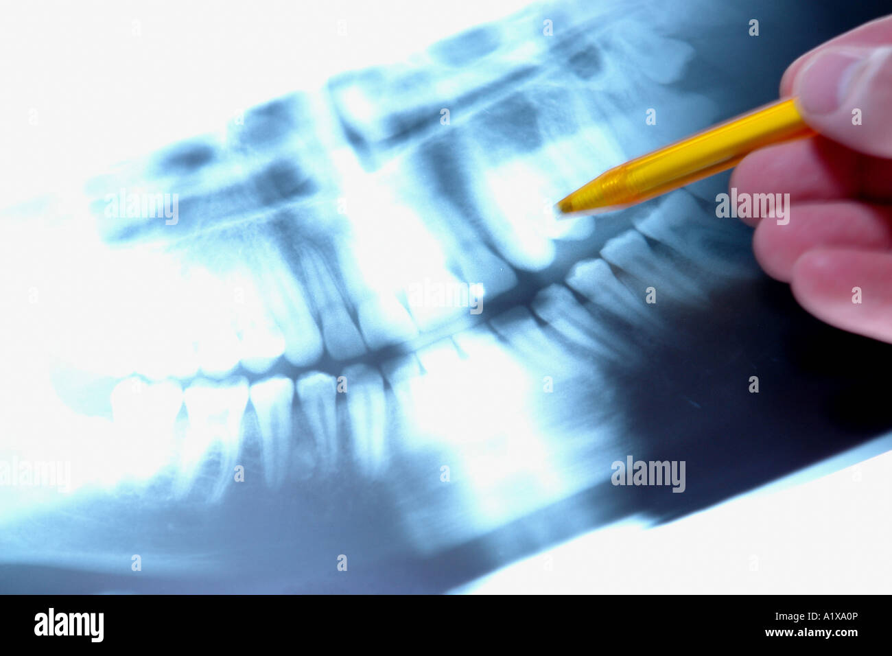 x-ray of the teeth Stock Photo - Alamy