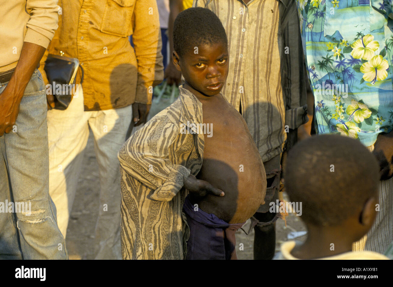 ANGOLA CIVIL WAR AUG 1993 YOUNG BOY WITH A SWOLEN ABDOMEN Stock Photo ...