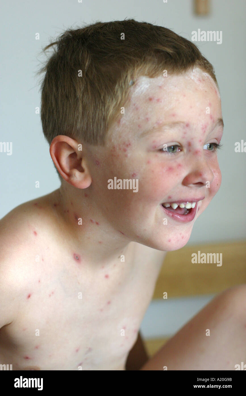 Chickenpox Scabs High Resolution Stock Photography and Images - Alamy