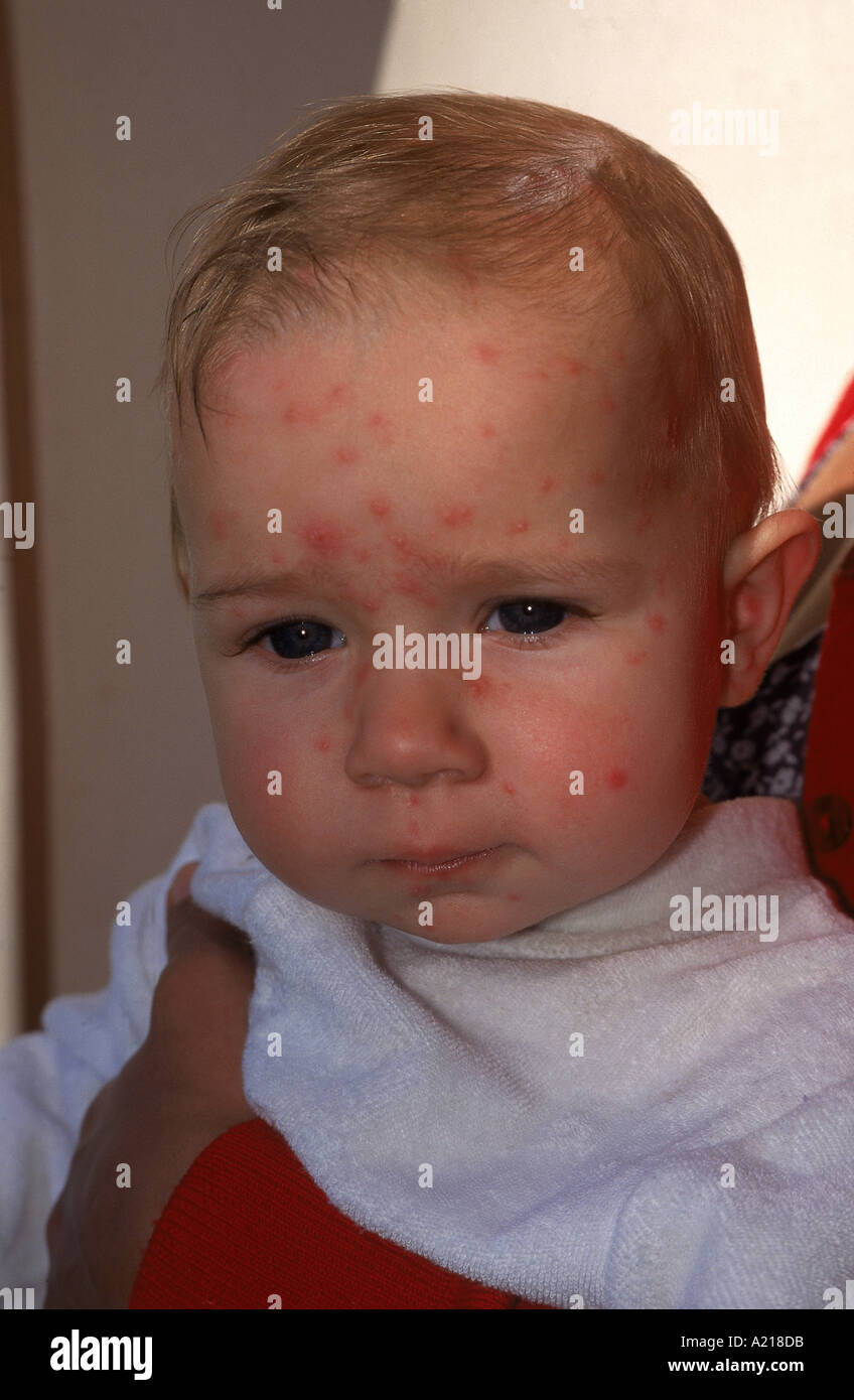 Baby chickenpox hi-res stock photography and images - Alamy