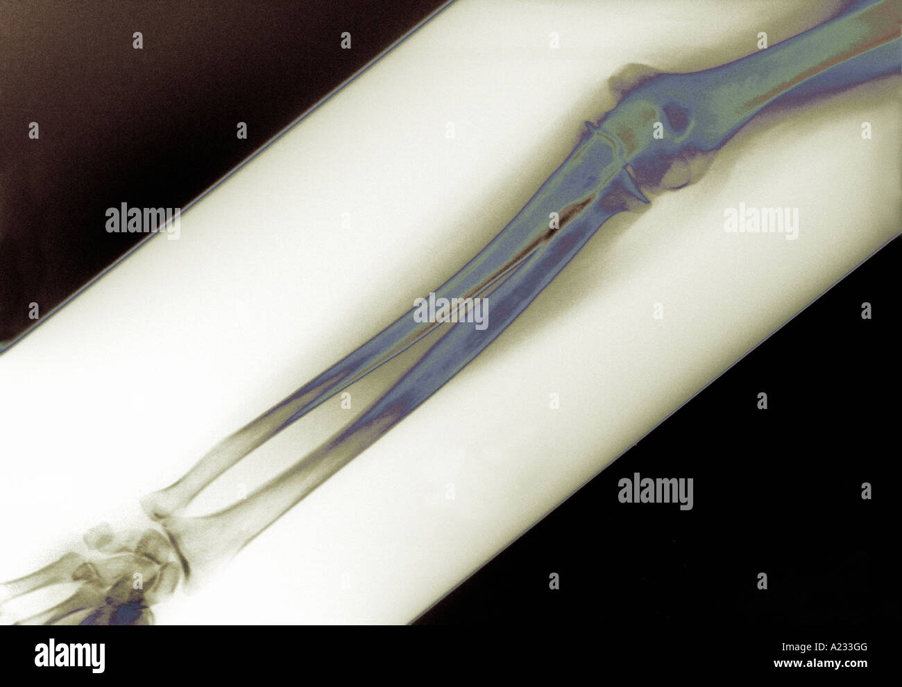 X-ray of left forearm. Medical bone imaging Stock Photo - Alamy