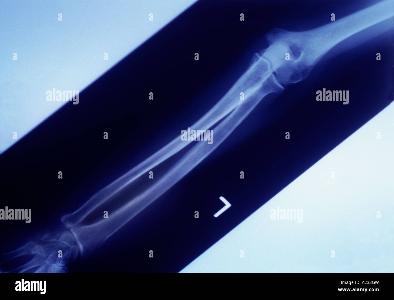 X Ray Of The Forearm Bones High Resolution Stock Photography and Images ...