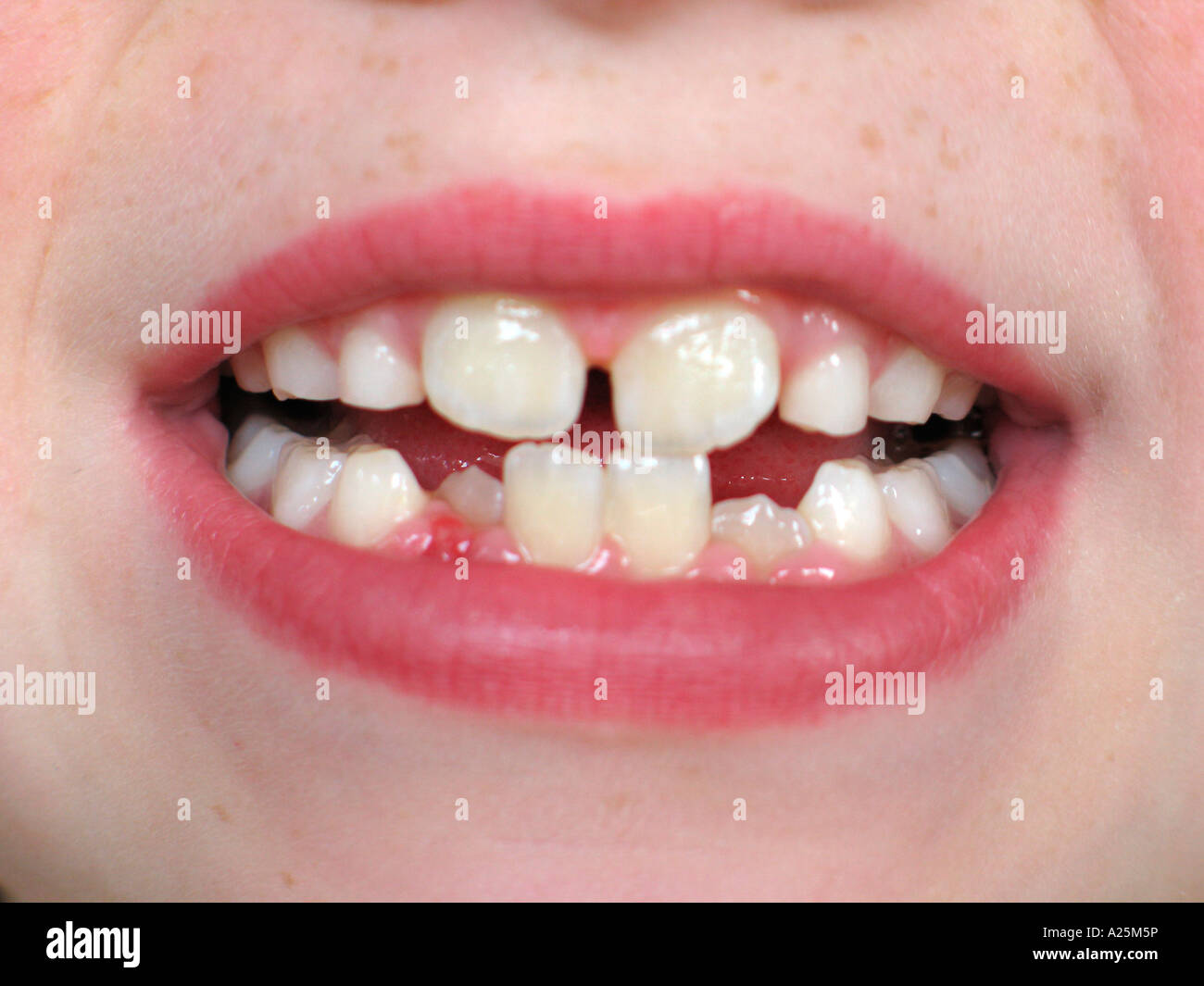 Childs teeth Stock Photo - Alamy