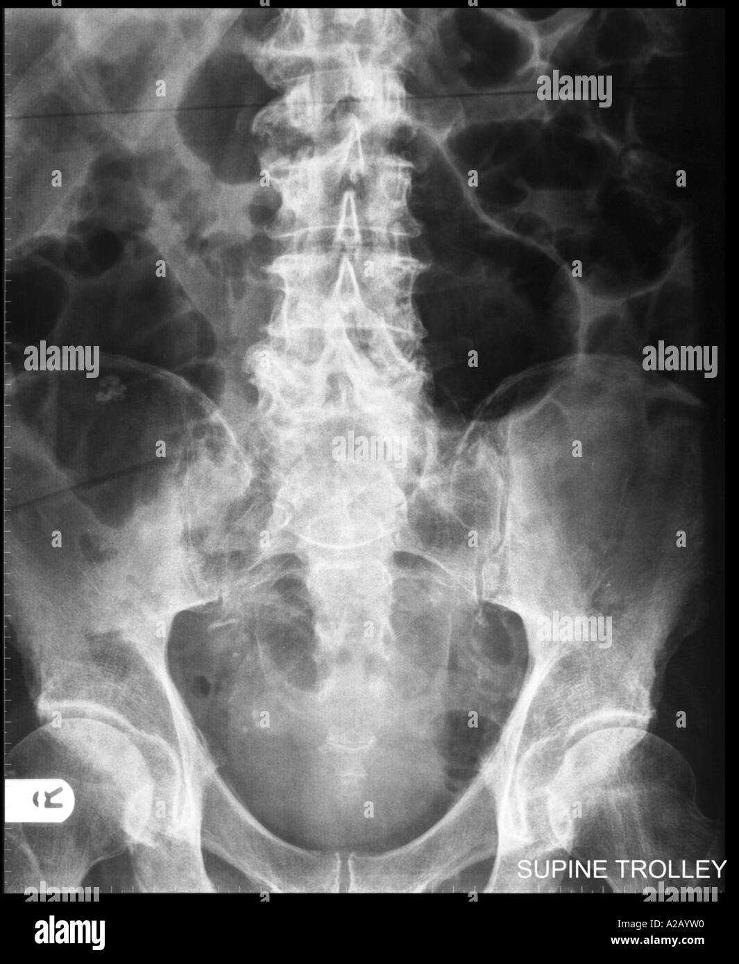 Distended abdomen hi-res stock photography and images - Alamy Distended abdomen hi-res stock photography and images - Alamy